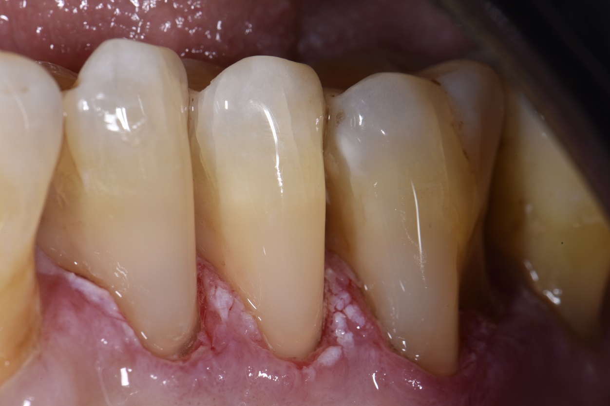 Extensive root abrasion restored biomimetically