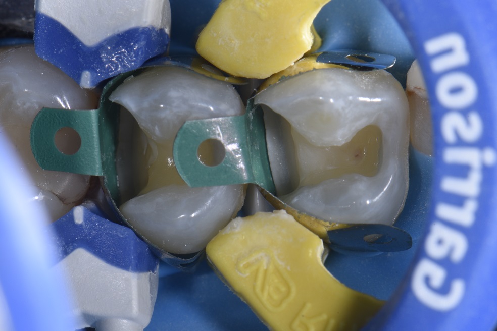 Mixture of different sectional matrix rings to achieve contact separation