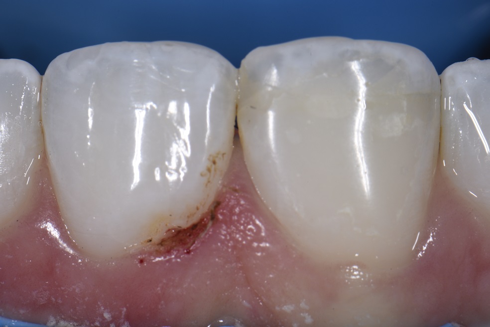 Closed Flap Crown Lengthening and Resin Enhancement of a Young Smile