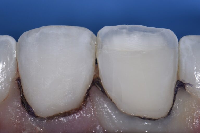 Closed Flap Crown Lengthening and Resin Enhancement of a Young Smile