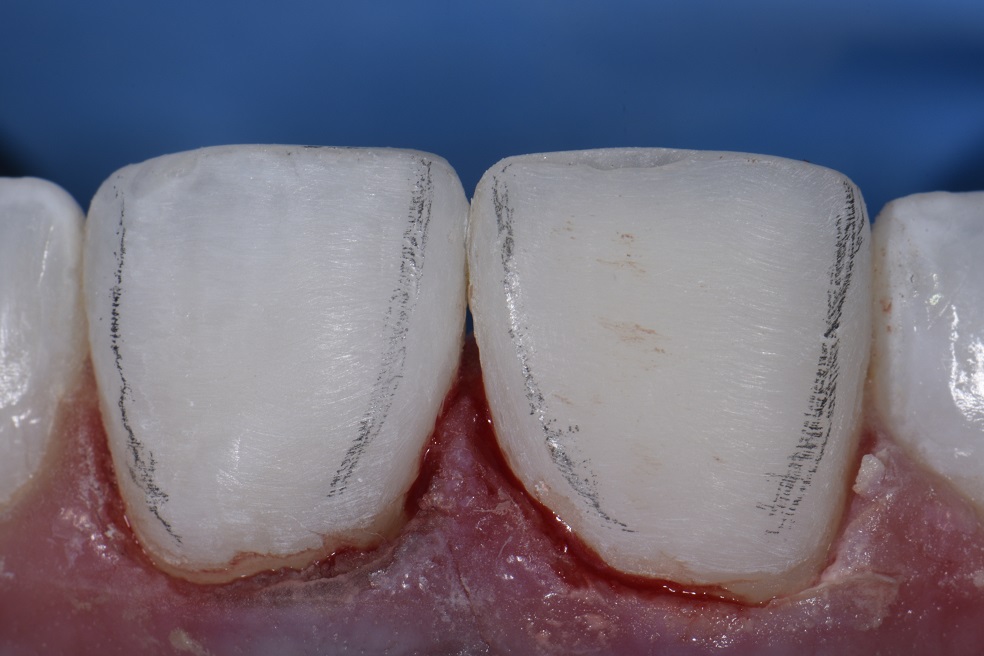 Closed Flap Crown Lengthening and Resin Enhancement of a Young Smile