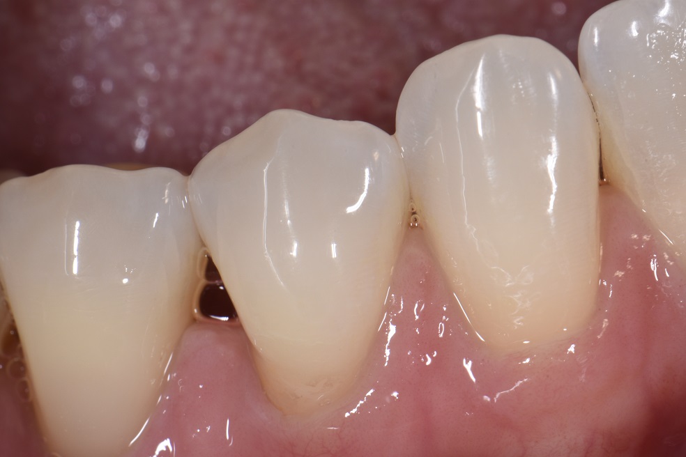 Cervical abrasion and root sensitivity