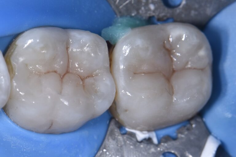 Multi-pit caries on a 16 year old female restored invisibly