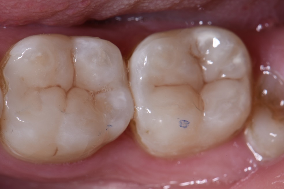 Multi-pit caries on a 16 year old female restored invisibly