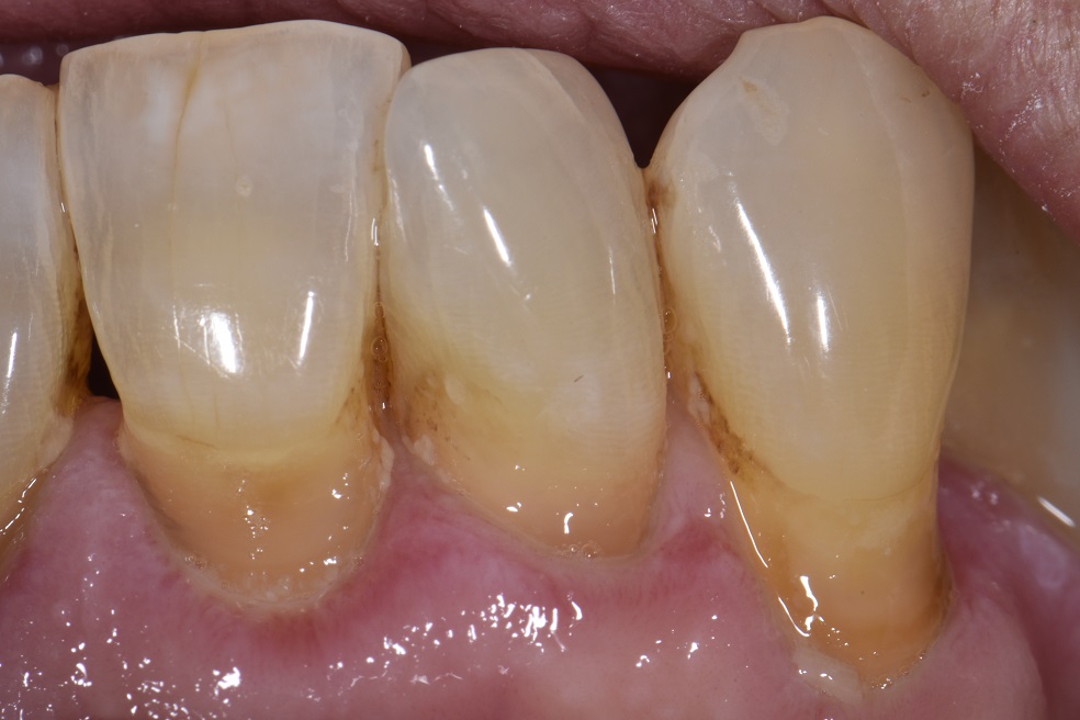 Long and large root surface lesions