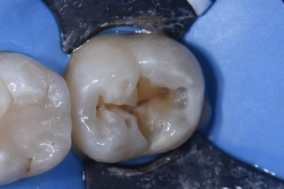 Selective fissure dissection in minimally invasive dentistry