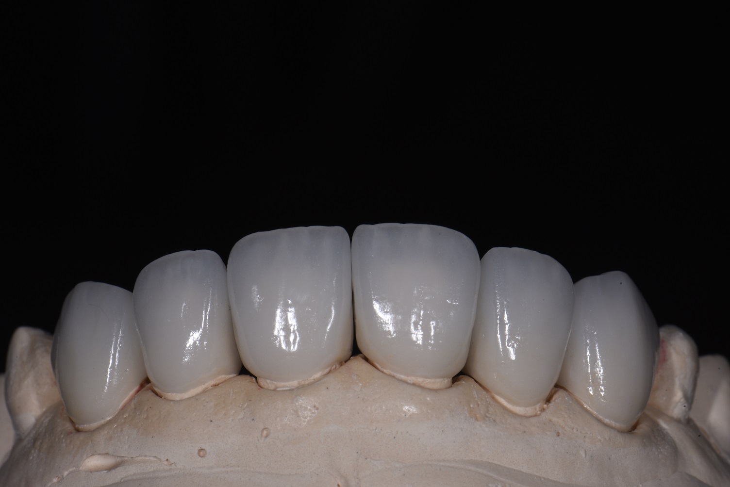 Ultrathin conservative crown preparations e_max HT