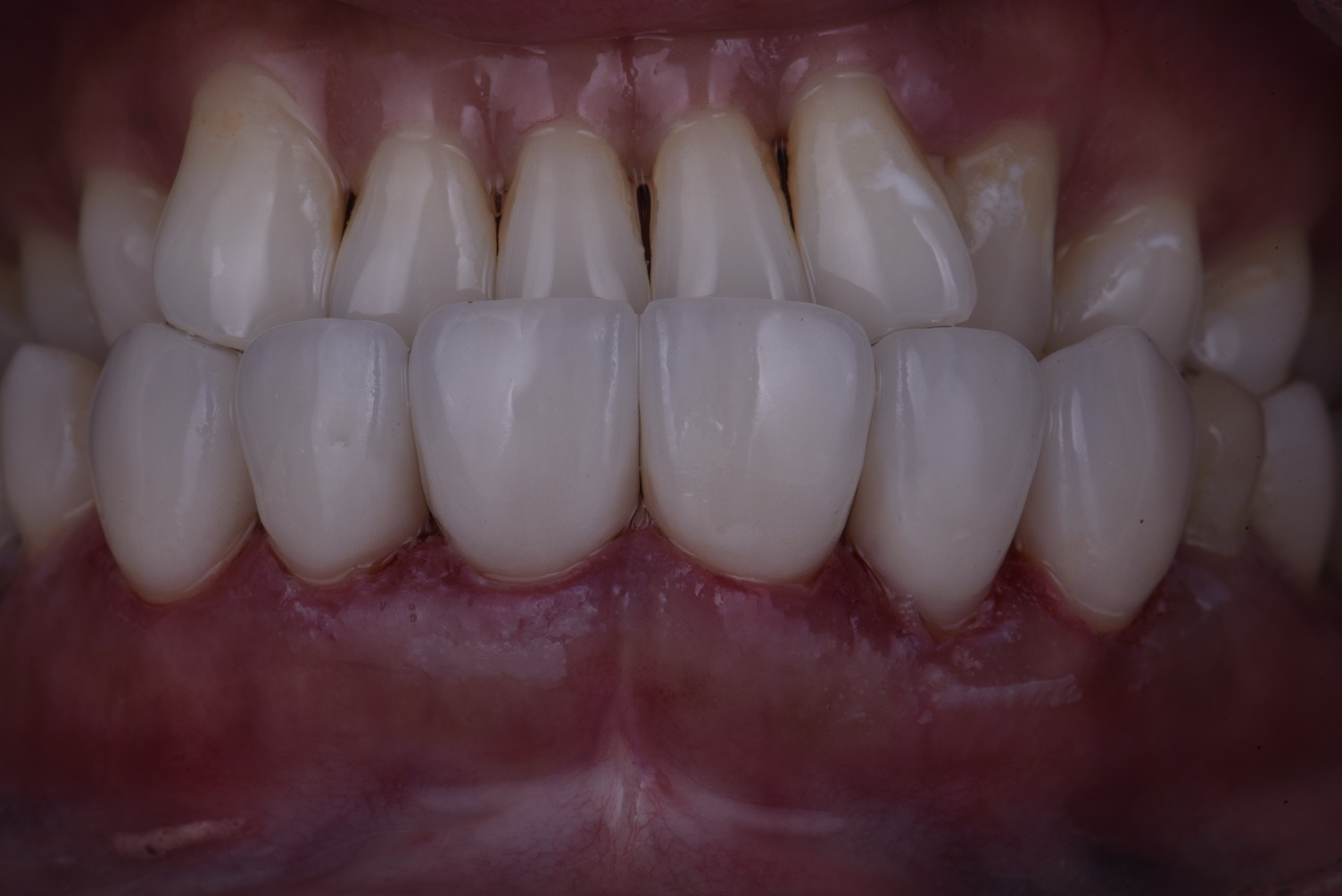 Ultrathin conservative crown preparations e_max HT