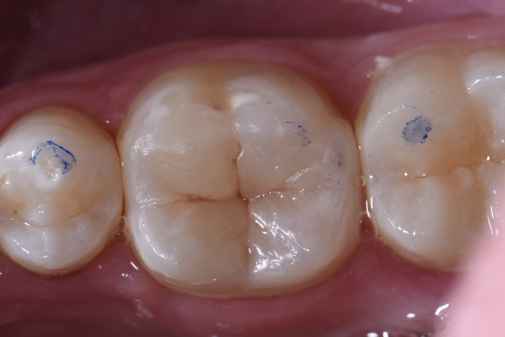 Minimally Invasive Restorative Dentistry