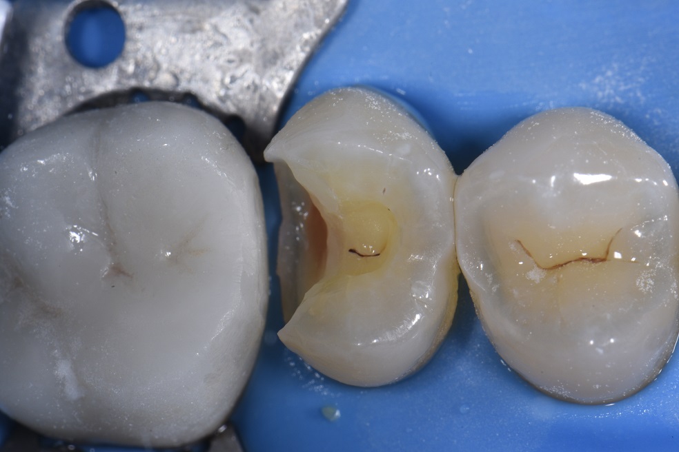 Class II precision using a GC Prototype Composite