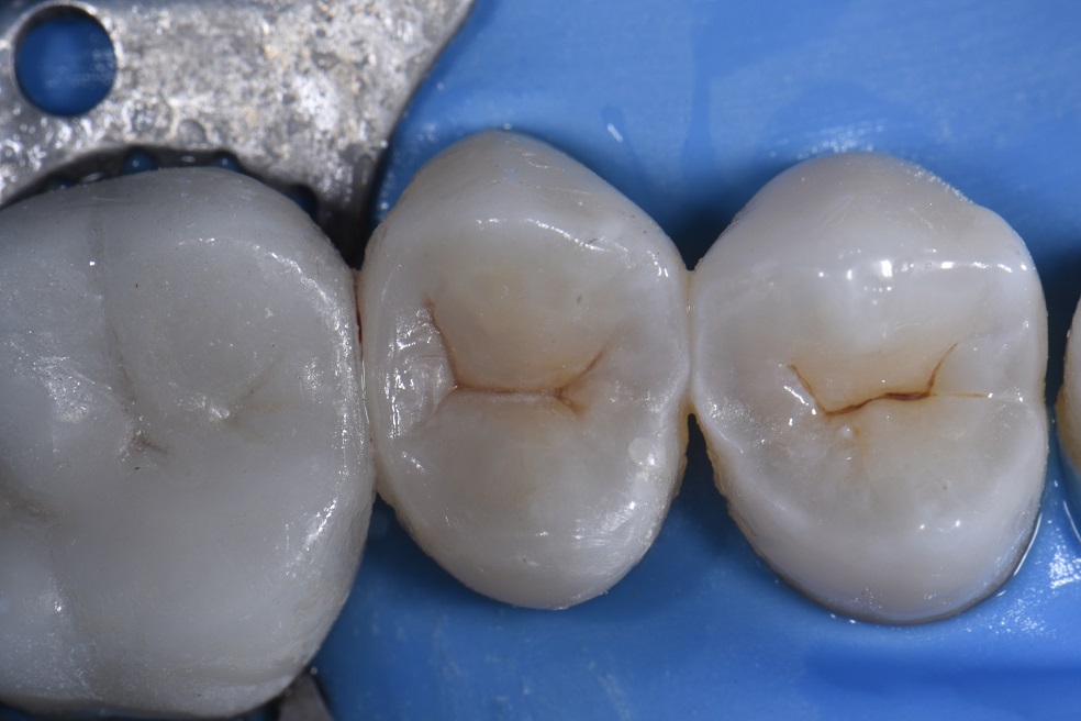 Class II precision using a GC Prototype Composite