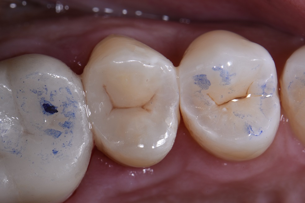 Class II precision using a GC Prototype Composite