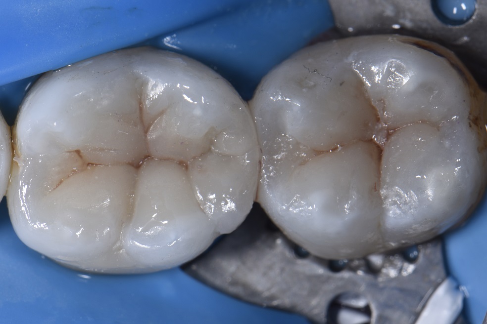 Occlusal adjustments in hyperfilled composite resin restorations