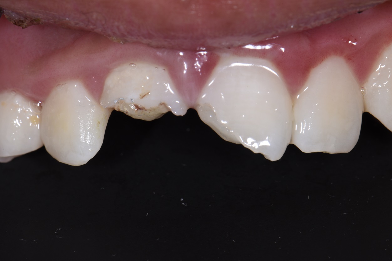 Trauma repair utilizing a partial tooth fragment on a root canaled tooth