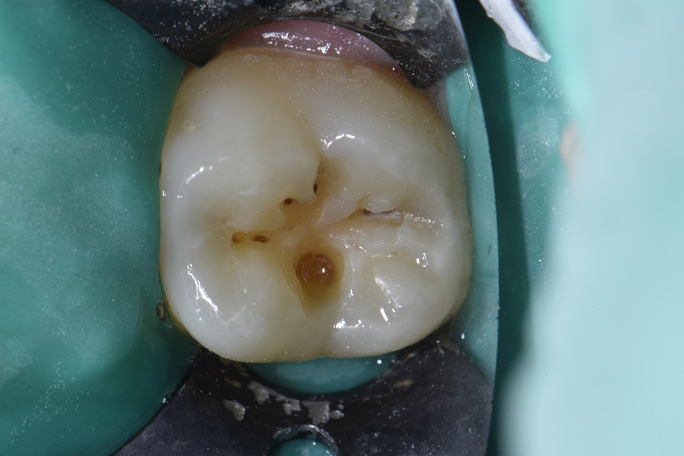 Fissurotomy carious ambushes