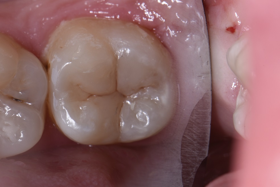 Fissurotomy carious ambushes