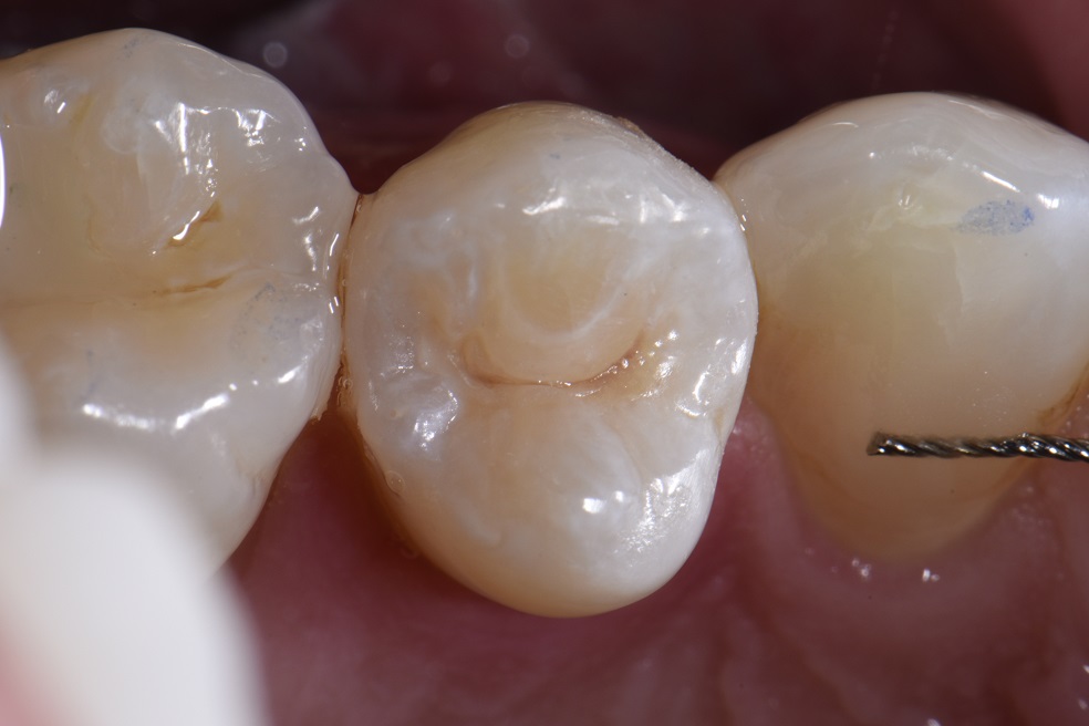 Wide fissurotomies restored with skulpted composite