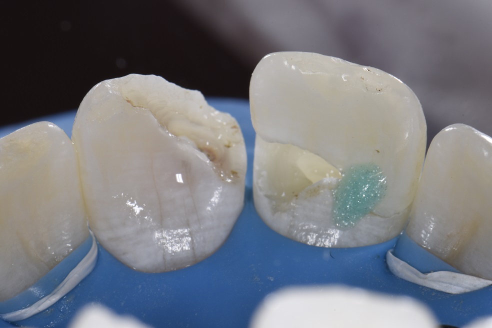 Trauma repair utilizing a partial tooth fragment on a root canaled tooth
