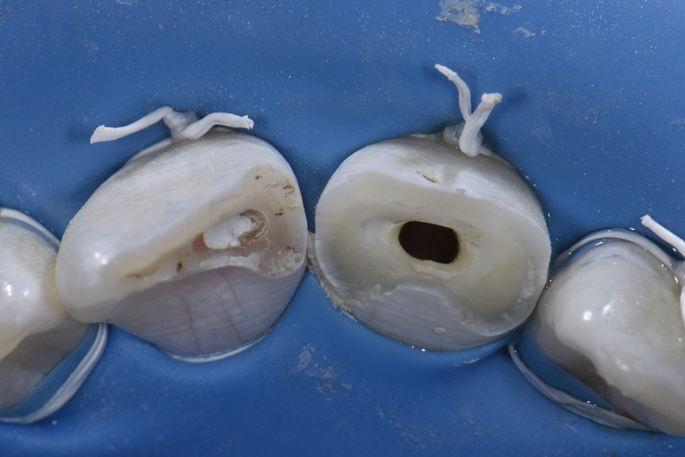 Trauma repair utilizing a partial tooth fragment on a root canaled tooth