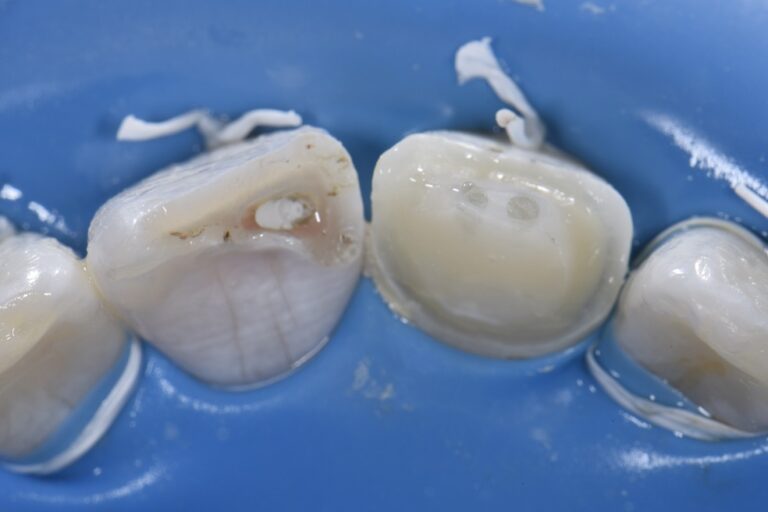 Trauma repair utilizing a partial tooth fragment on a root canaled tooth