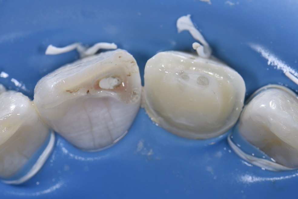 Trauma repair utilizing a partial tooth fragment on a root canaled tooth