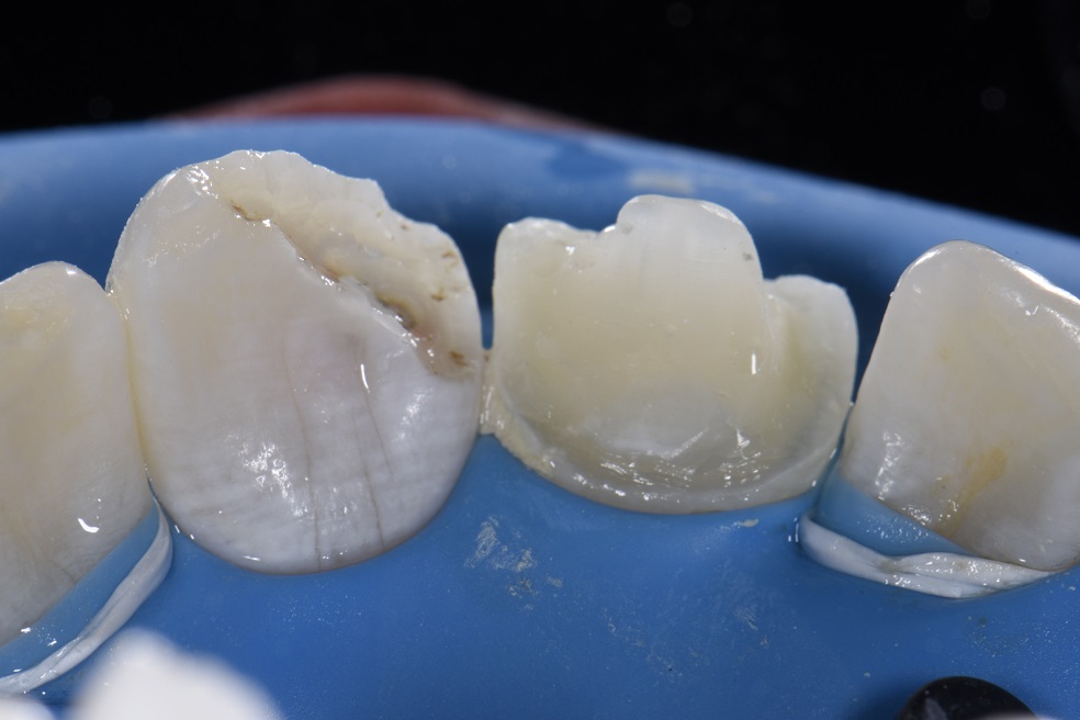 Trauma repair utilizing a partial tooth fragment on a root canaled tooth