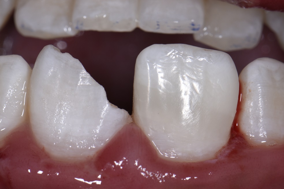 Trauma repair utilizing a partial tooth fragment on a root canaled tooth
