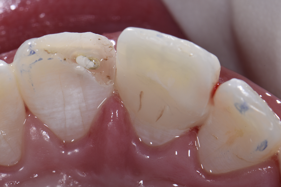 Trauma repair utilizing a partial tooth fragment on a root canaled tooth