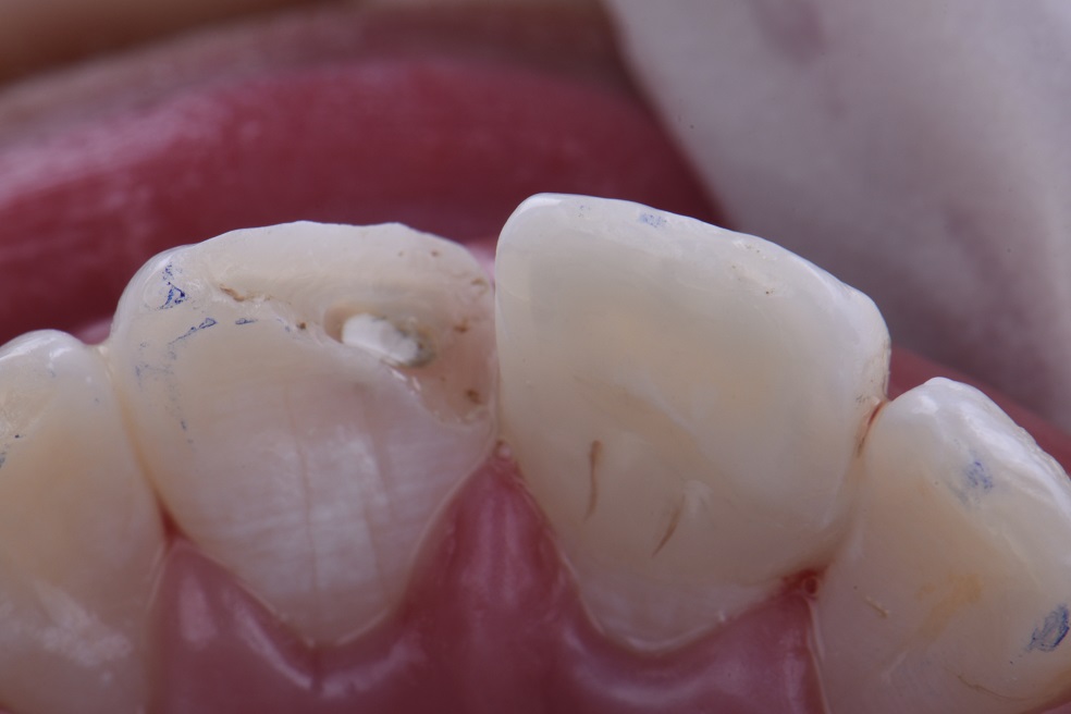 Trauma repair utilizing a partial tooth fragment on a root canaled tooth