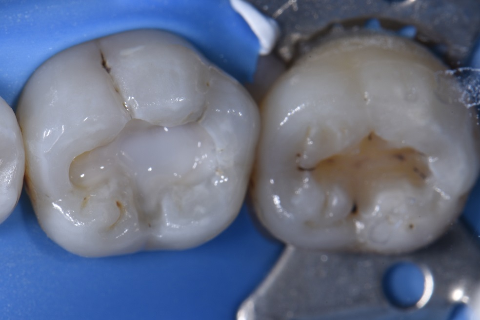 GC Prototype Composite and Dark Tooth blockout technique