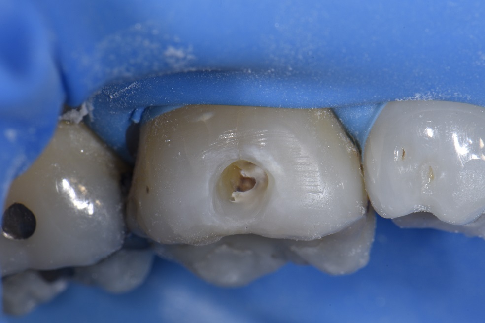 Reestablishing a strong hybrid layer