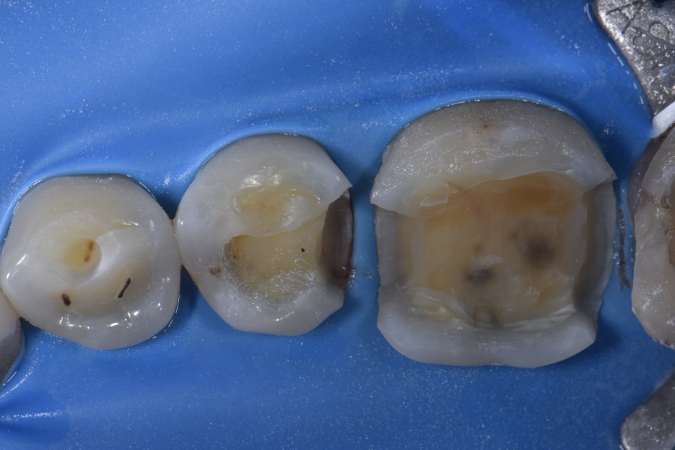 Restoring quadrants with biomimetic dentistry