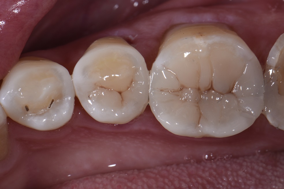 Restoring quadrants with biomimetic dentistry