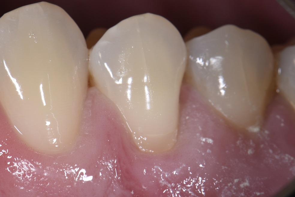 Root protection using composite resin