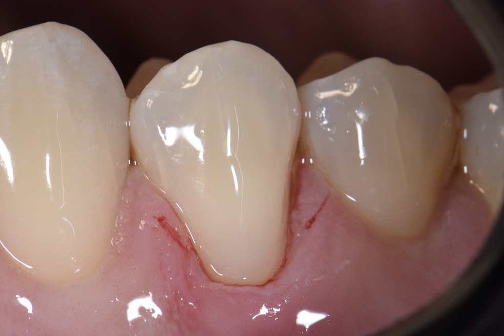 Root protection using composite resin