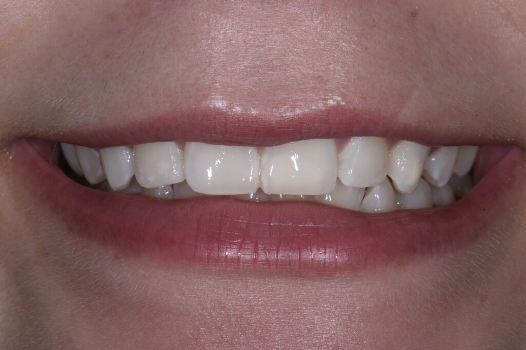 Resin infiltration and conservative composite layering