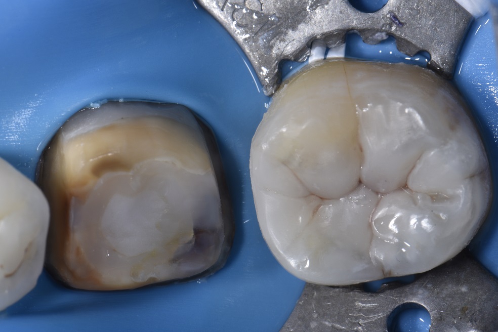 Voco Grandio SO Restorative Workflow