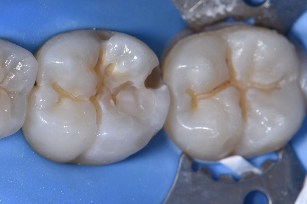 Minimally Invasive Dentistry