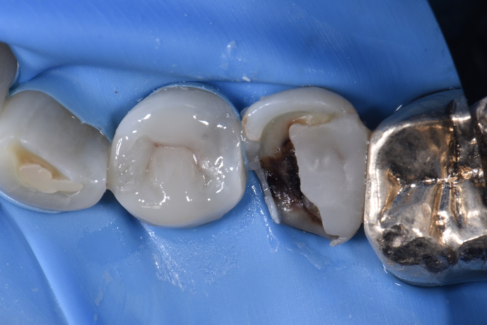 Rebuilding the bite from lost fillings