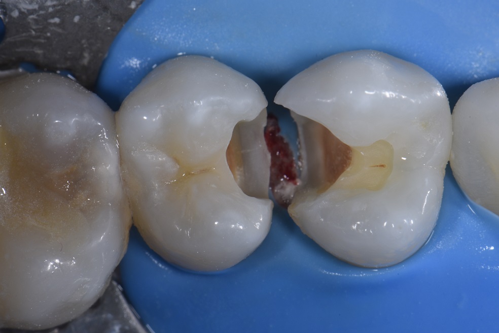 Back to back deep cavities