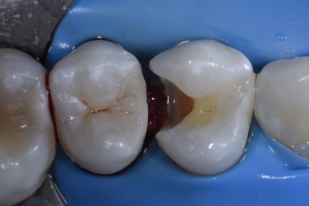 Back to back deep cavities