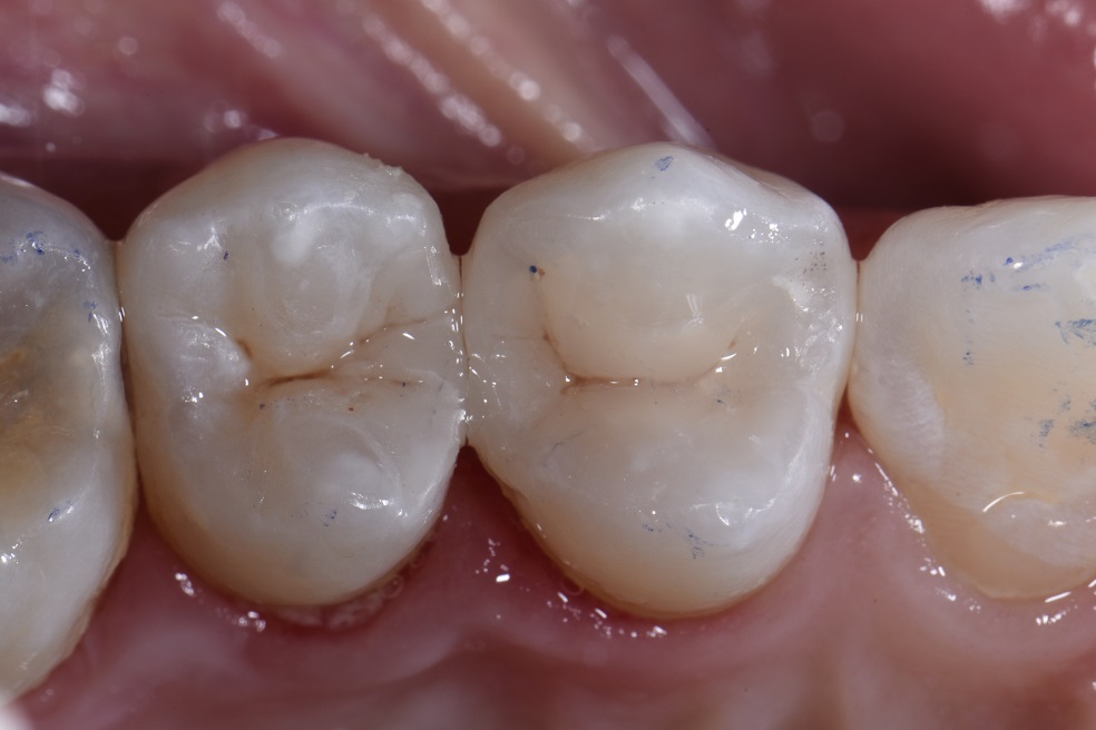 Back to back deep cavities