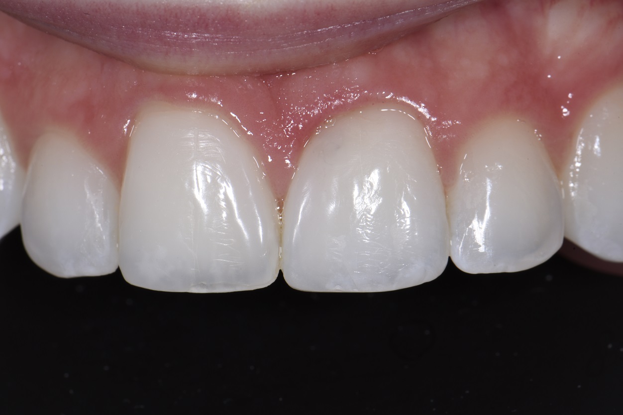 Esthetic Harmony in High End Direct Composite Artistry