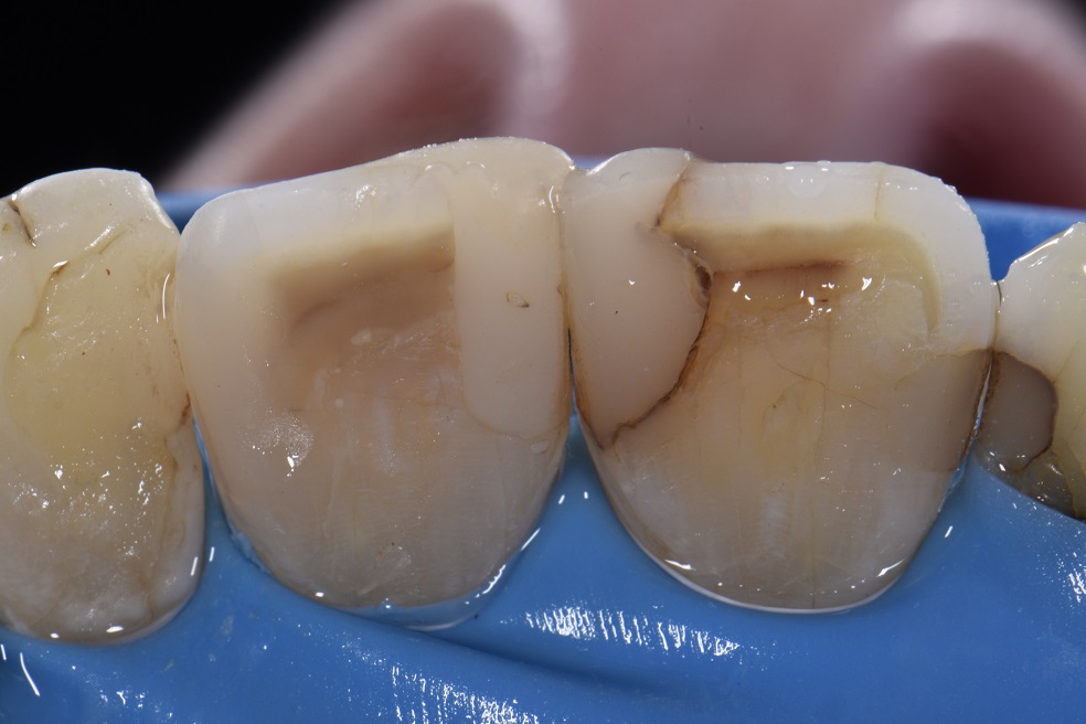 Restoring teeth with a dental supercomposite material