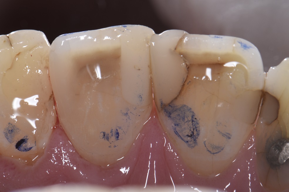 Restoring teeth with a dental supercomposite material