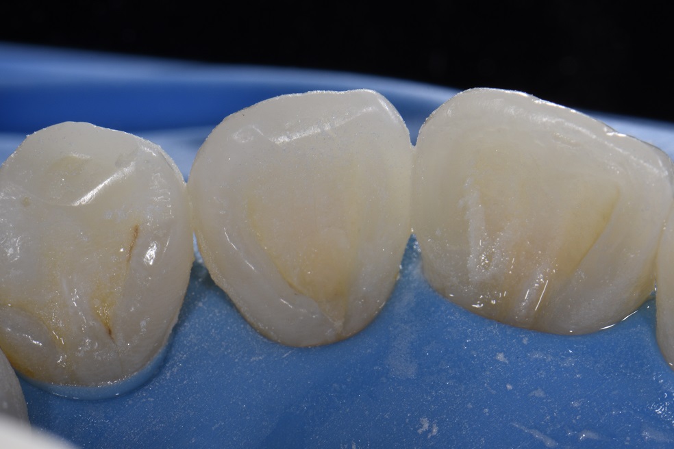 Dens Invaginatus Restorations that Mimic Nature