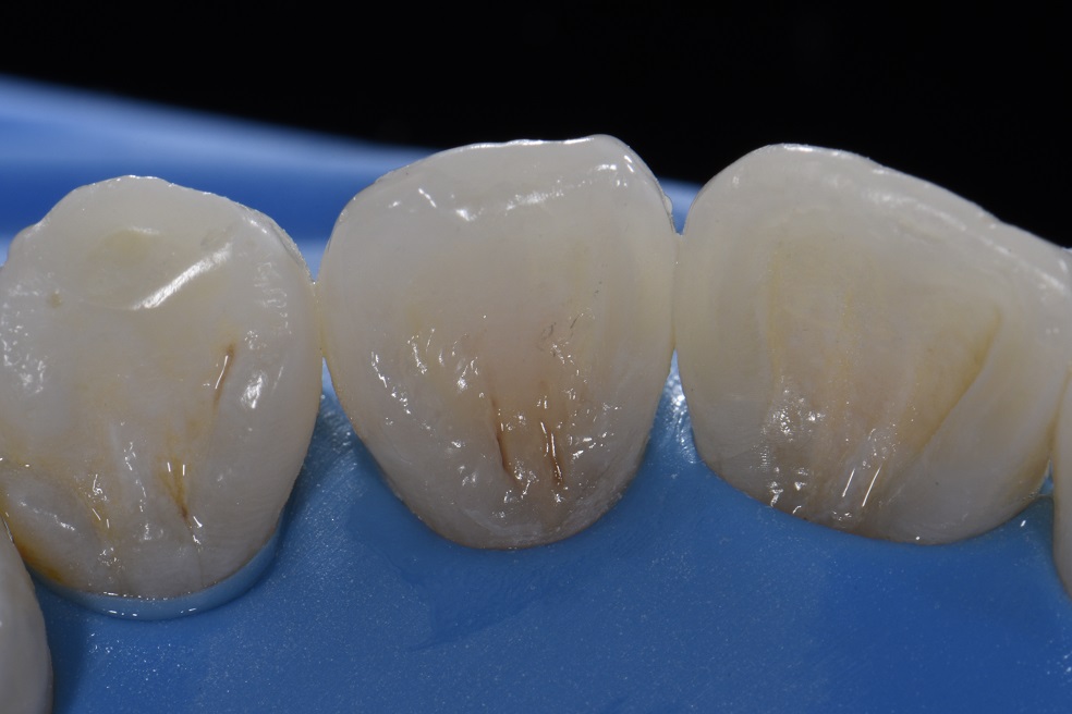 Dens Invaginatus Restorations that Mimic Nature