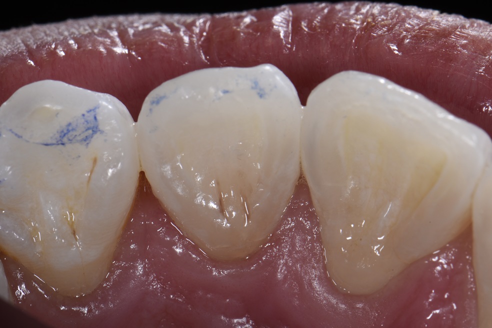 Dens Invaginatus Restorations that Mimic Nature