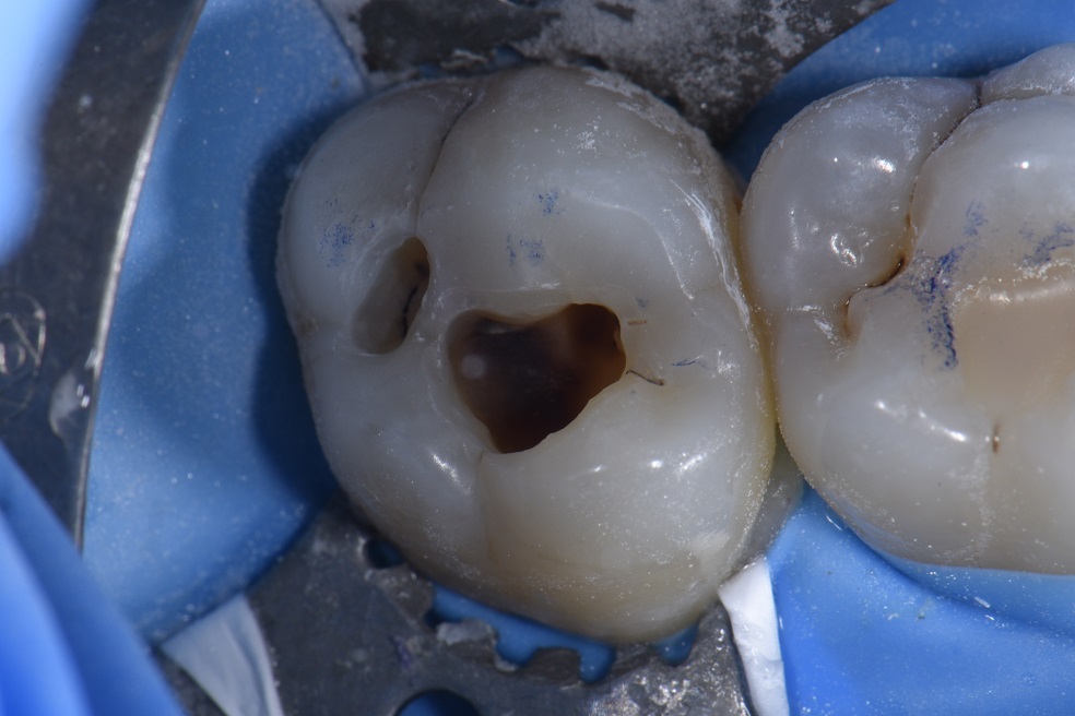 Blocking out Darkly stained dentin from cavities