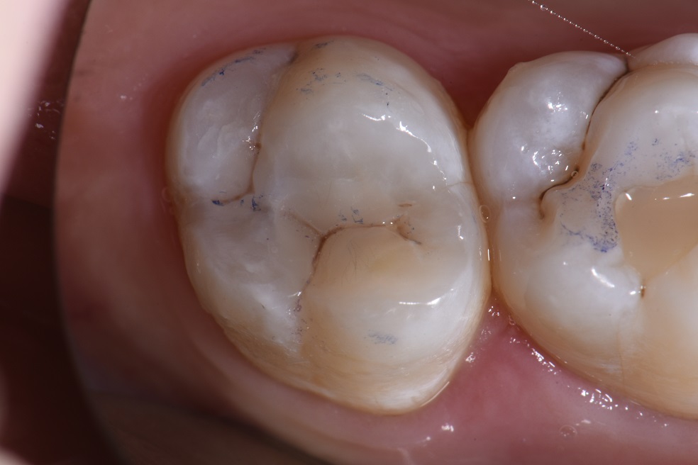 Blocking out Darkly stained dentin from cavities